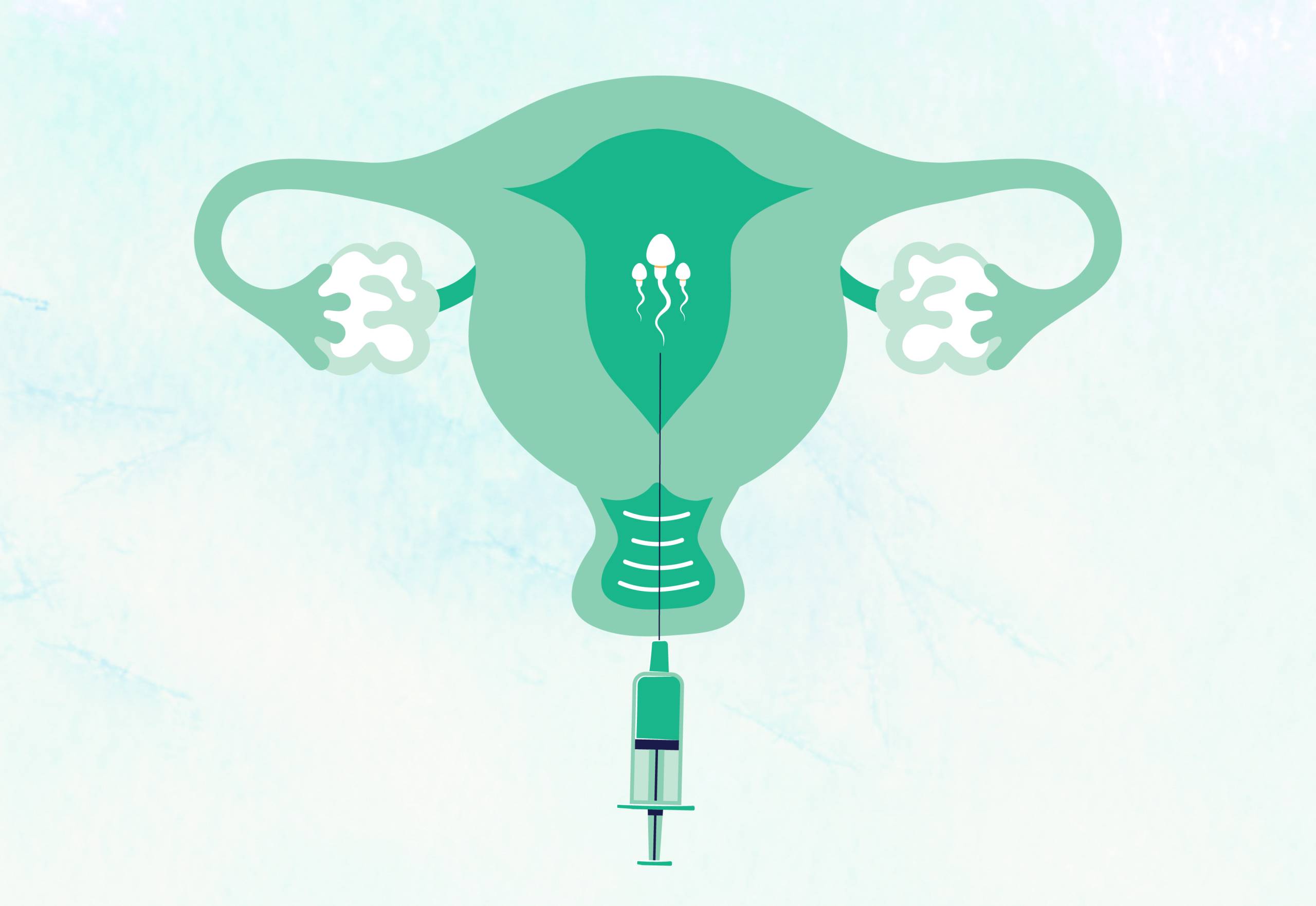 การรักษาภาวะมีบุตรยากโดยวิธี IUI - Genesis Fertility Center (GFC)